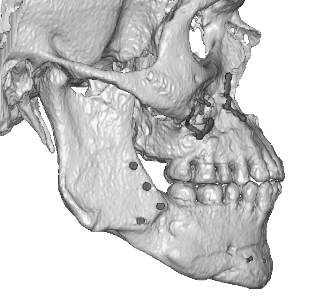 Plastic Surgery Case Study - Custom Jawline Implant for Smoothing The Irregular Inferior Border ...