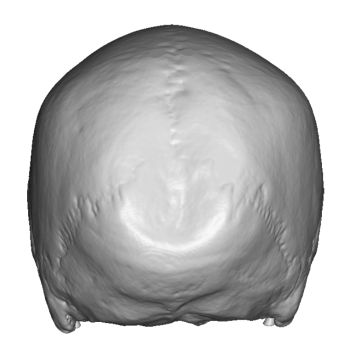 skull reshaping Archives - Explore Plastic Surgery