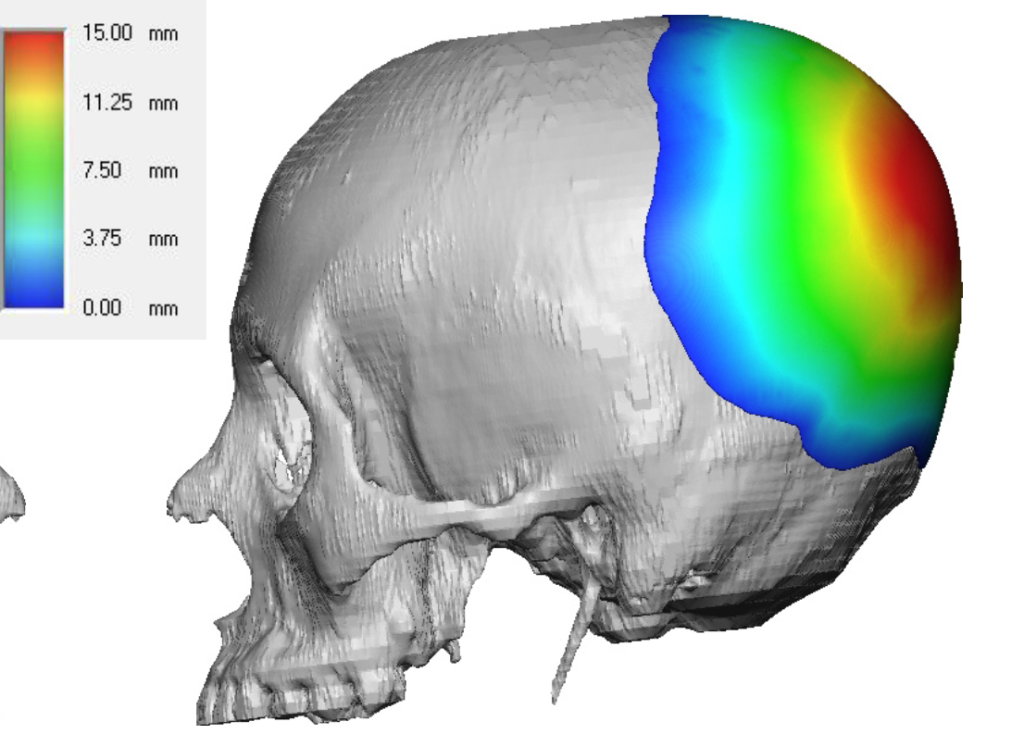 Plastic Surgery Case Study - Female Back of the Head Custom Skull ...