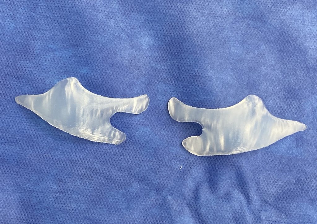 Plastic Surgery Case Study - Custom Infraorbital-Malar-Maxillary ...