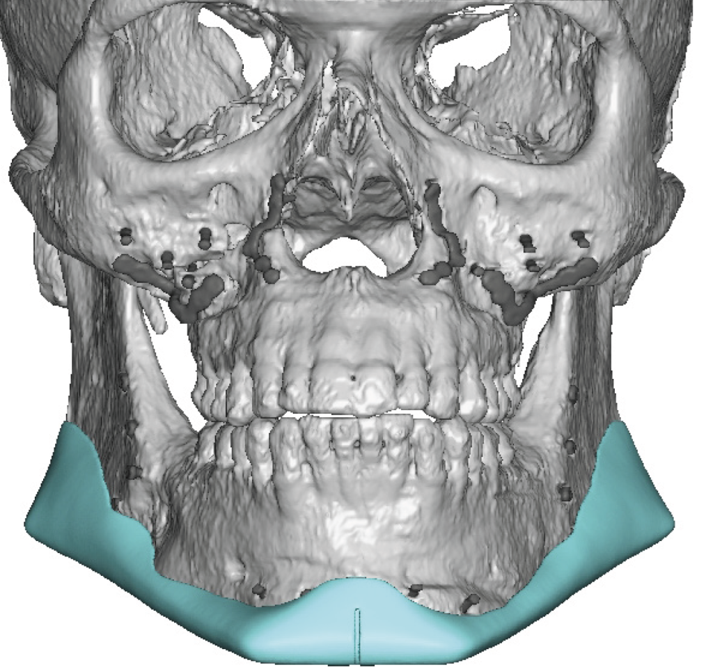 Plastic Surgery Case Study - Custom Jawline Implant for Smoothing The Irregular Inferior Border ...