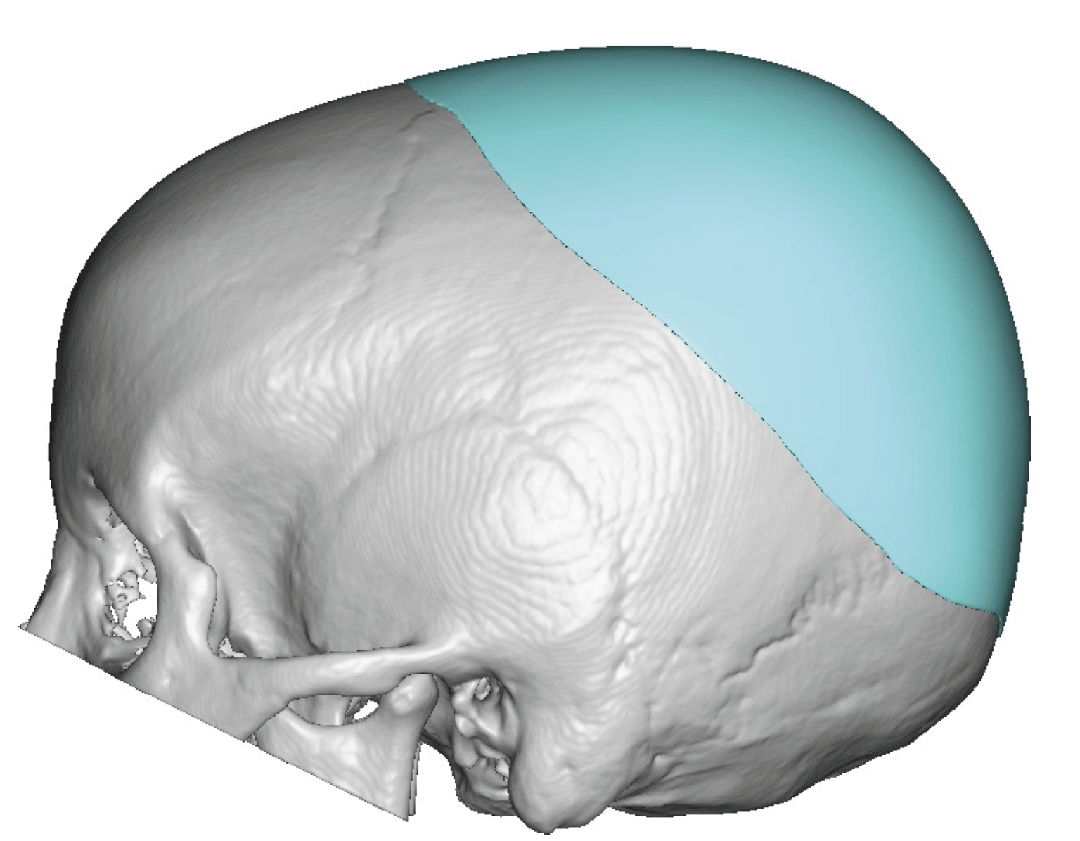 Plastic Surgery Case Study - Custom Skull Implant for Correction of ...