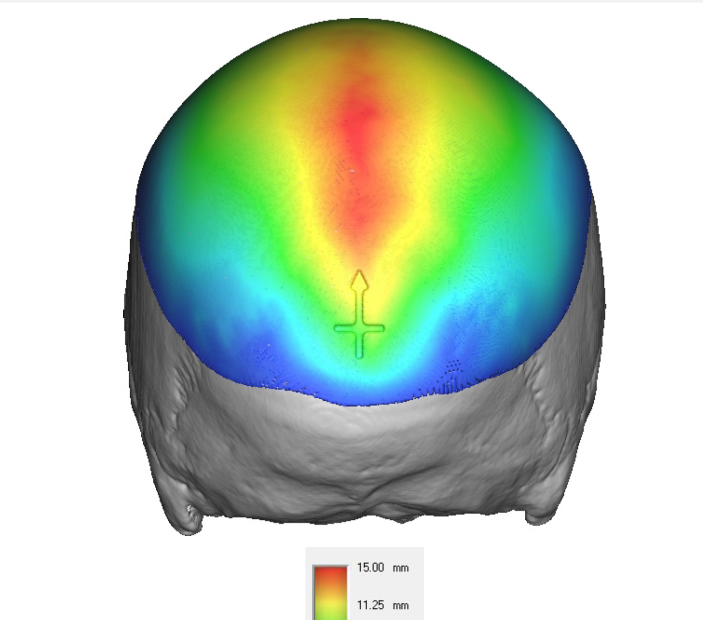 Plastic Surgery Case Study - Custom Skull Implant for Correction of ...
