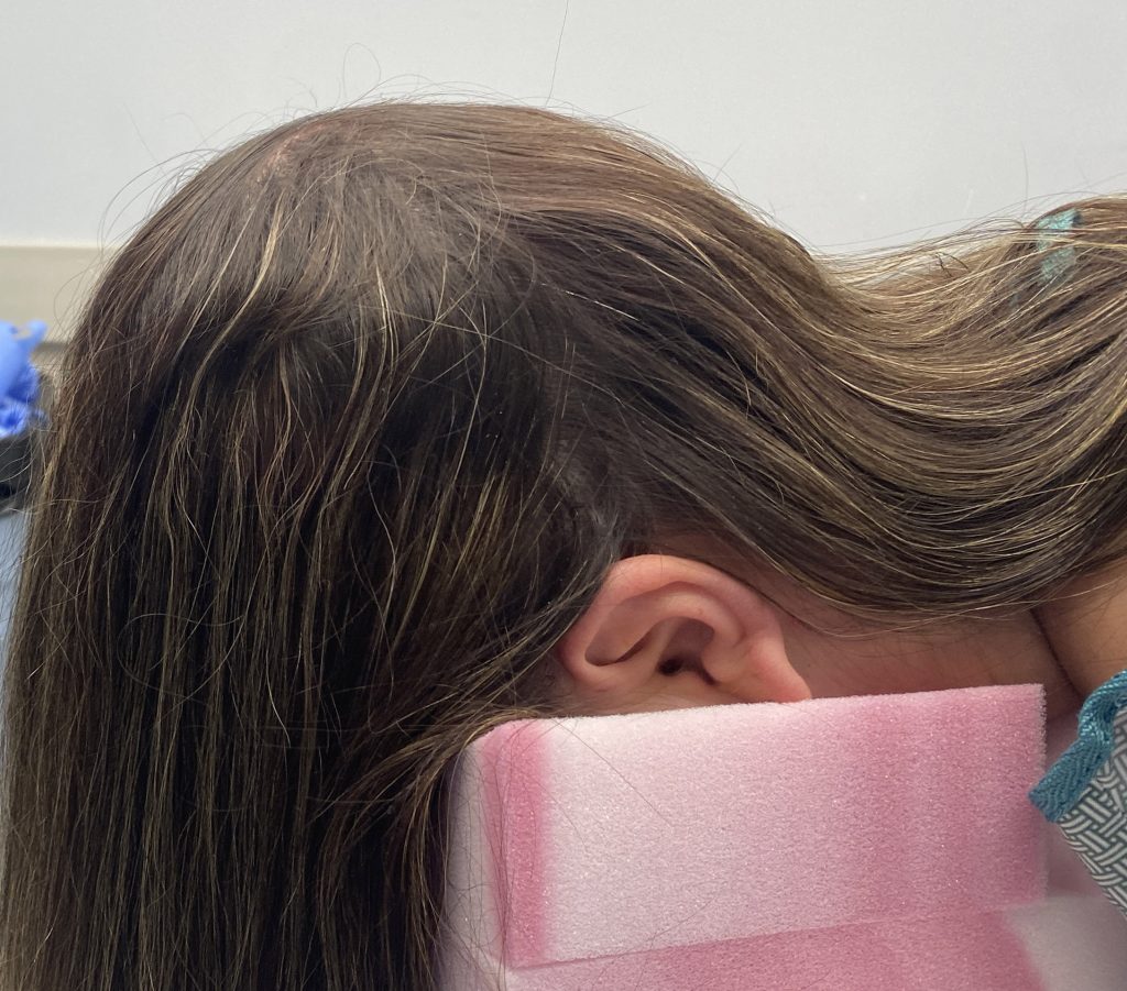 Plastic Surgery Case Study - Custom Skull Implant for Correction of ...