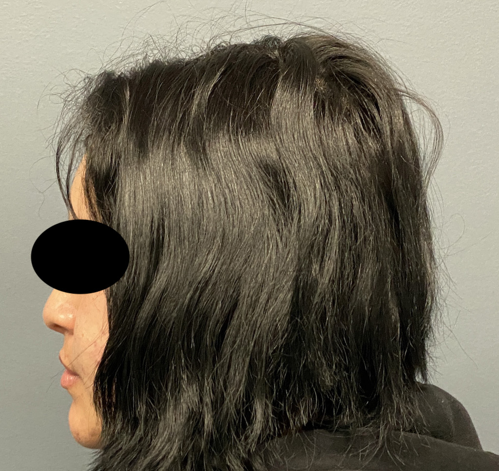 Plastic Surgery Case Study - Female Back of the Head Custom Skull ...