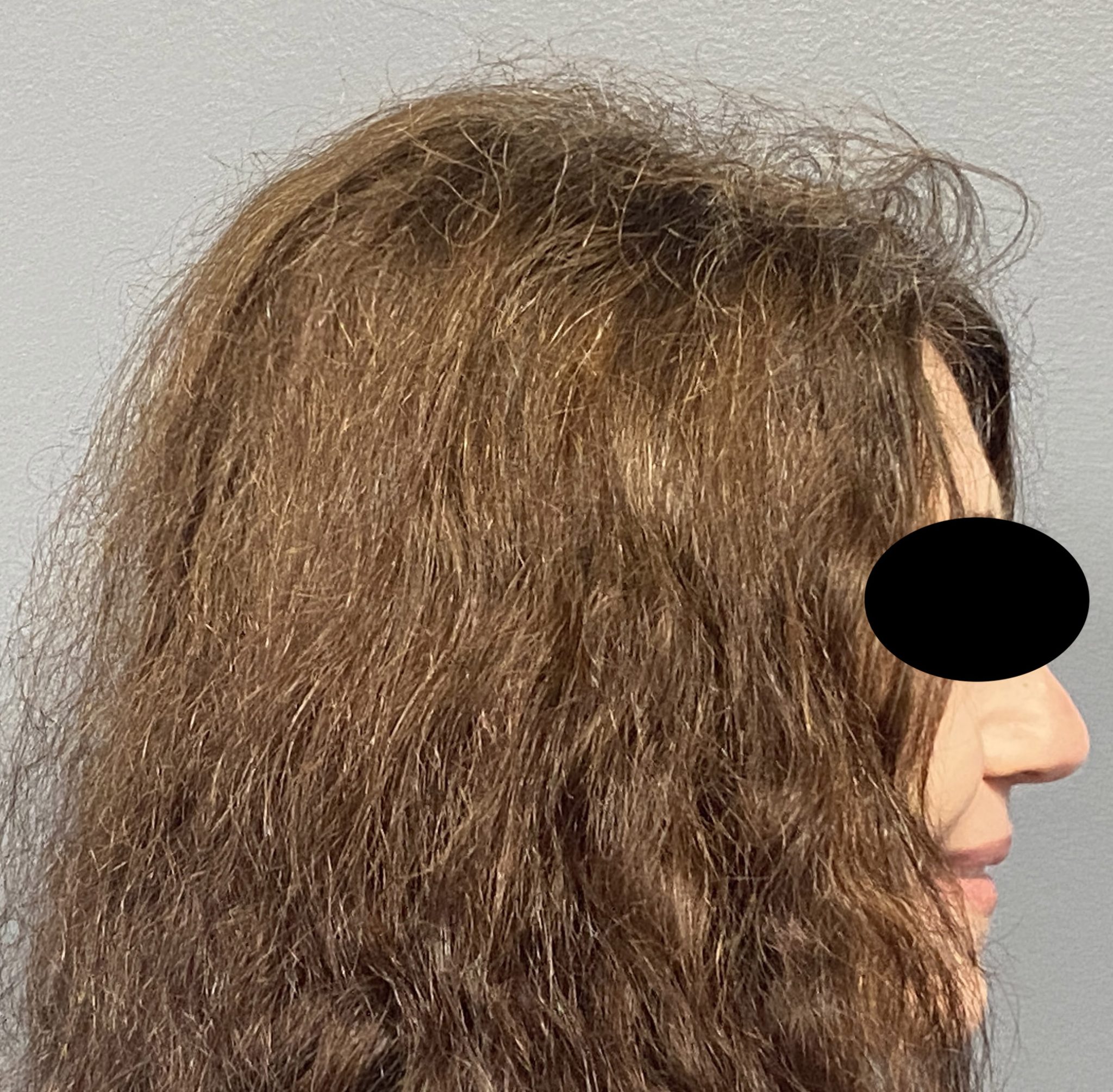 Plastic Surgery Case Study - Two Stage Large Skull Augmentation with ...