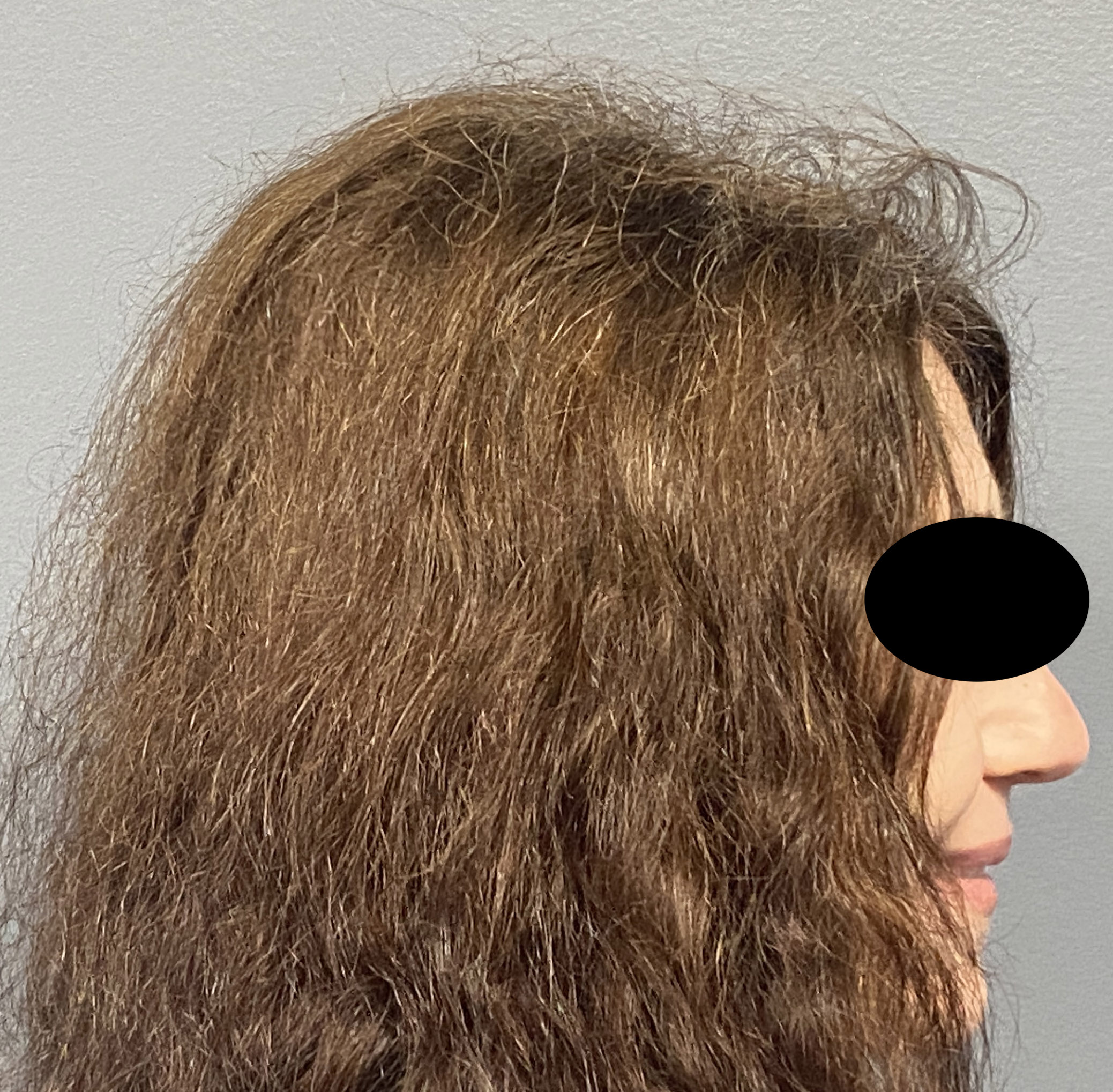 female large skull implant side 2 Dr Barry Eppley copy - Explore ...