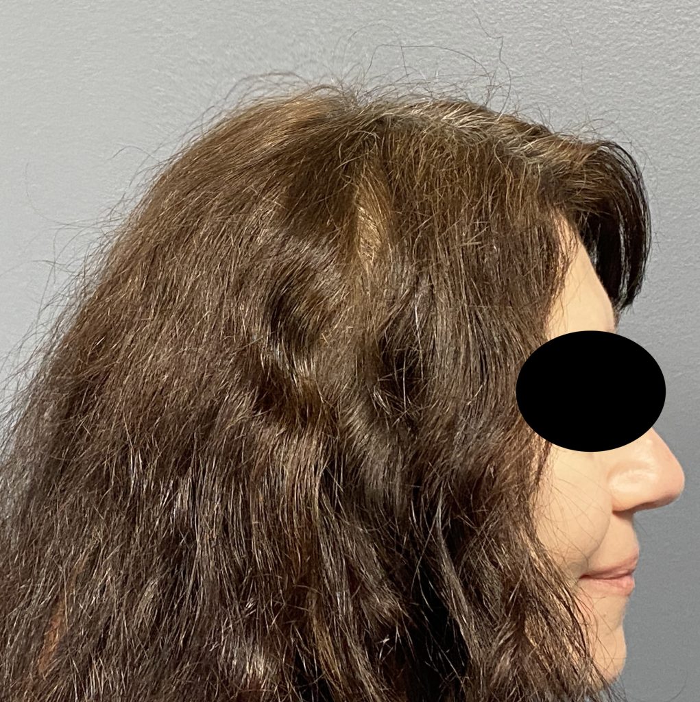 Plastic Surgery Case Study - Two Stage Large Skull Augmentation with ...
