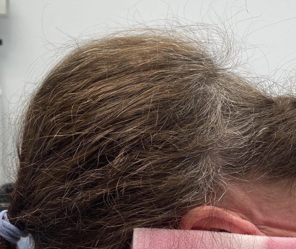 Plastic Surgery Case Study - Two Stage Large Skull Augmentation with ...