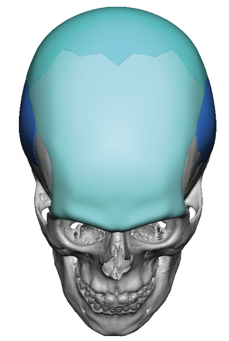 five surface custom skull implants design top view Dr Barry Eppley ...