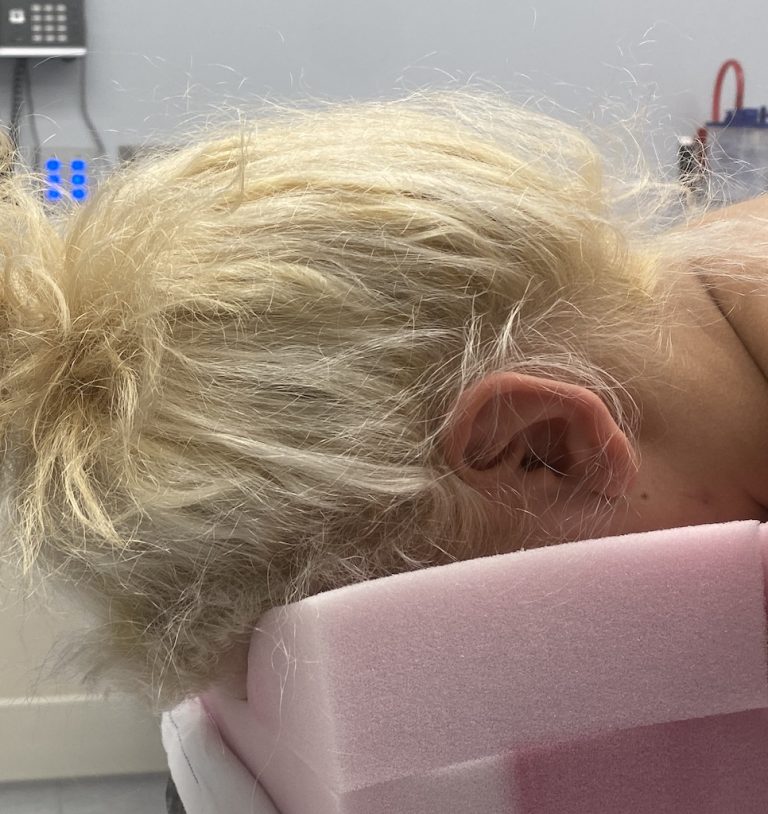 intraoperaruve positioning for scalp expander placement Dr Barry Eppley ...