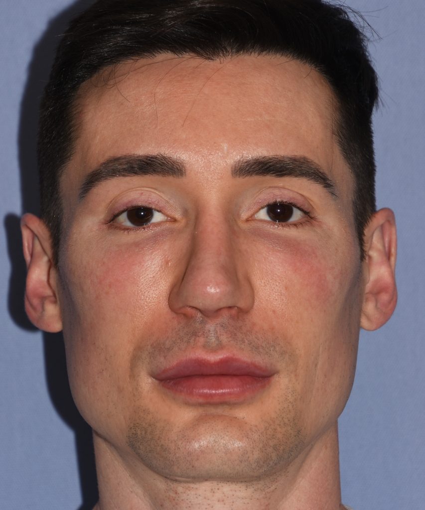 Plastic Surgery Case Study - Male Custom Infraorbital-Malar Implants ...