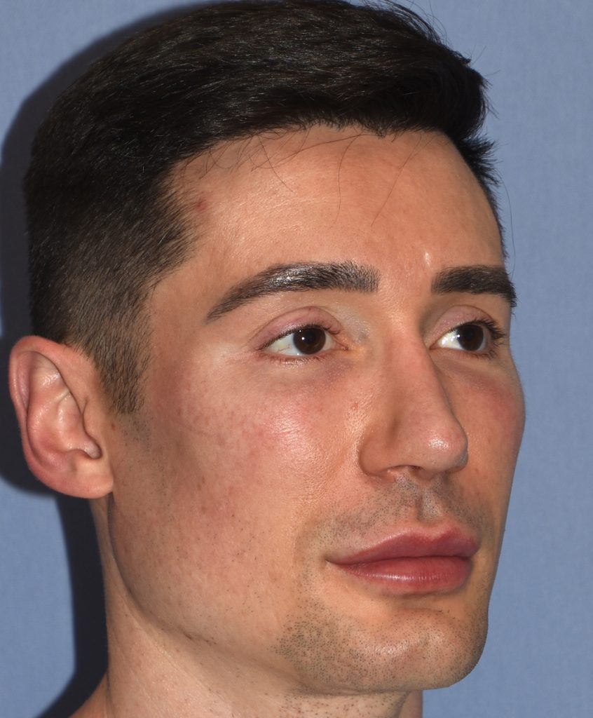 Plastic Surgery Case Study - Male Custom Infraorbital-Malar Implants ...