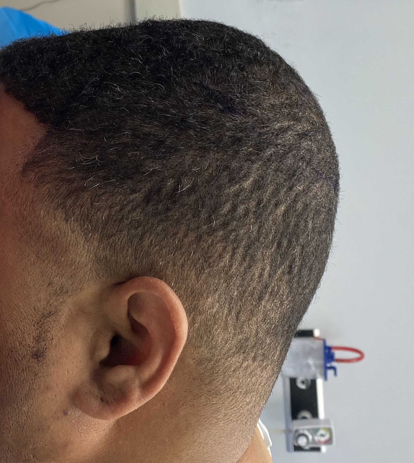 Plastic Surgery Case Study - BiParietal Skull Reduction with A ...