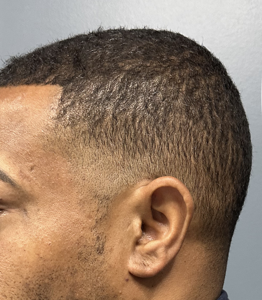 Plastic Surgery Case Study - BiParietal Skull Reduction with A ...