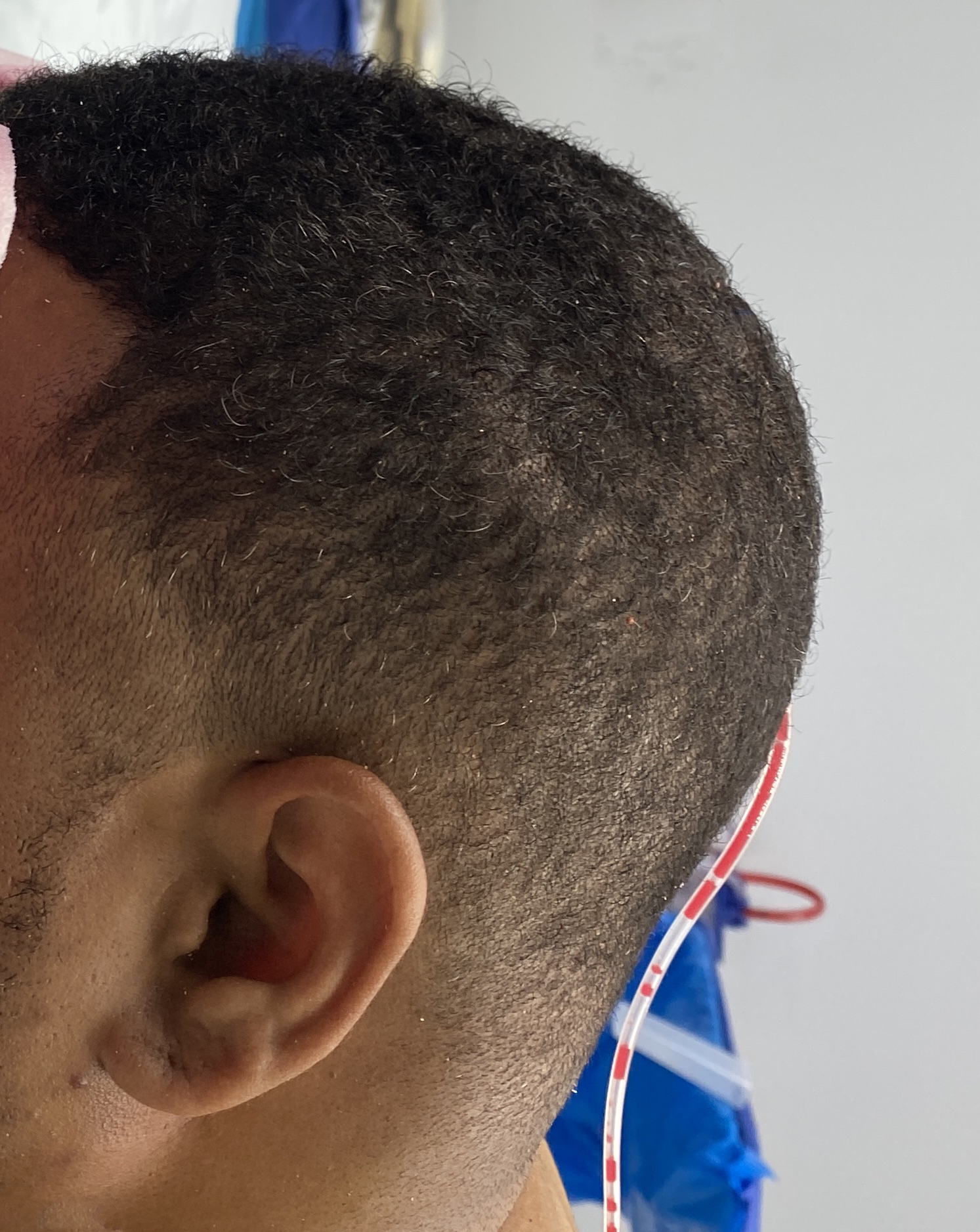 Plastic Surgery Case Study - BiParietal Skull Reduction with A ...