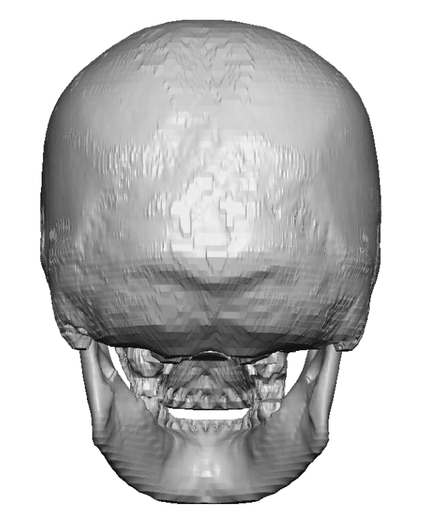 Plastic Surgery Case Study - Female Back of the Head Custom Skull ...