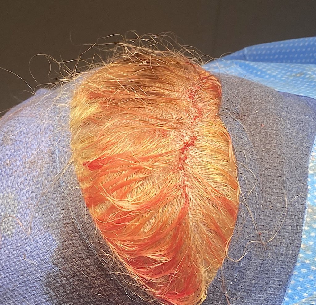 scalp tissue expander closure side view Dr Barry Eppley - Explore ...