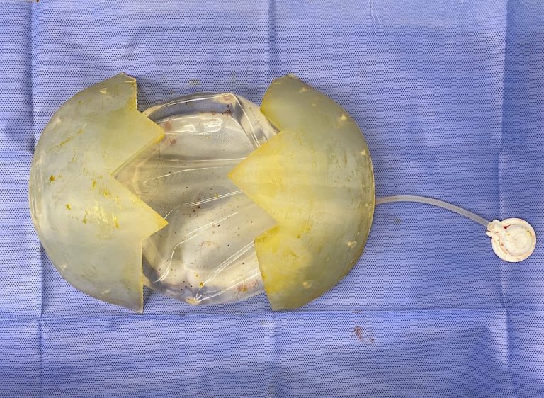 Plastic Surgery Case Study - Two Stage Large Skull Augmentation with ...