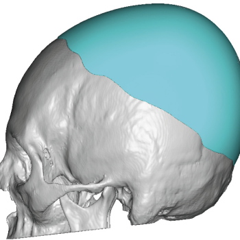skull reshaping Archives - Explore Plastic Surgery