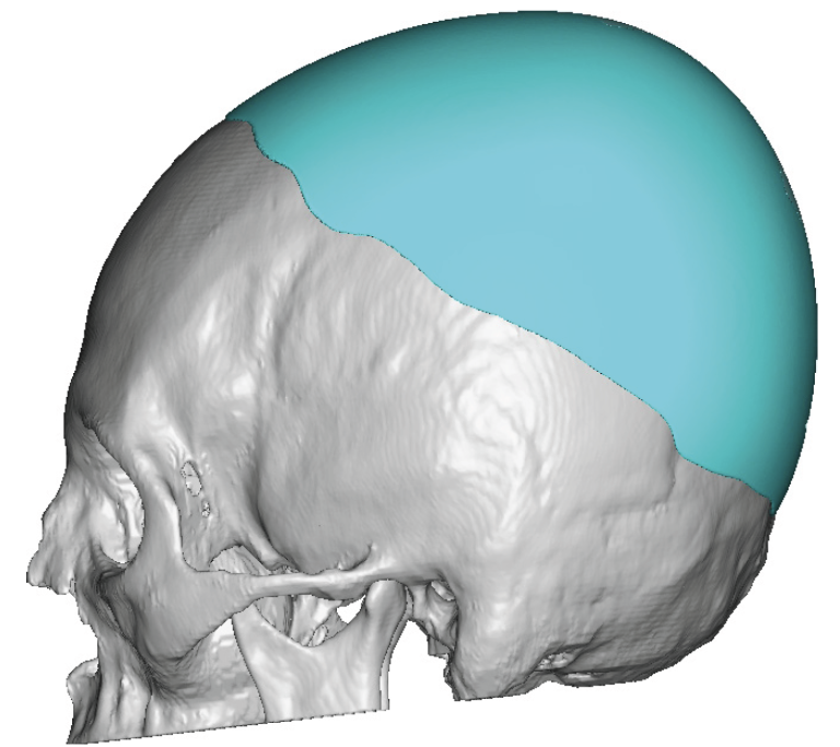 Plastic Surgery Case Study - Two Stage Large Skull Augmentation with ...