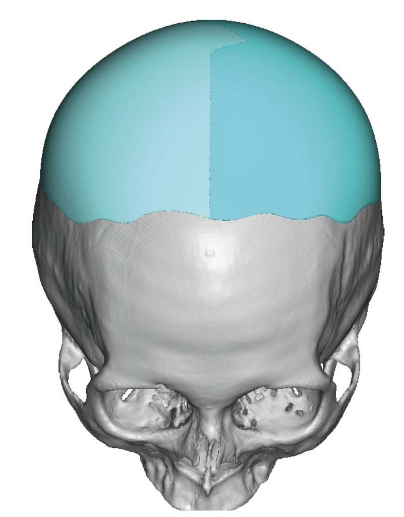 Plastic Surgery Case Study - Two Stage Large Skull Augmentation with ...
