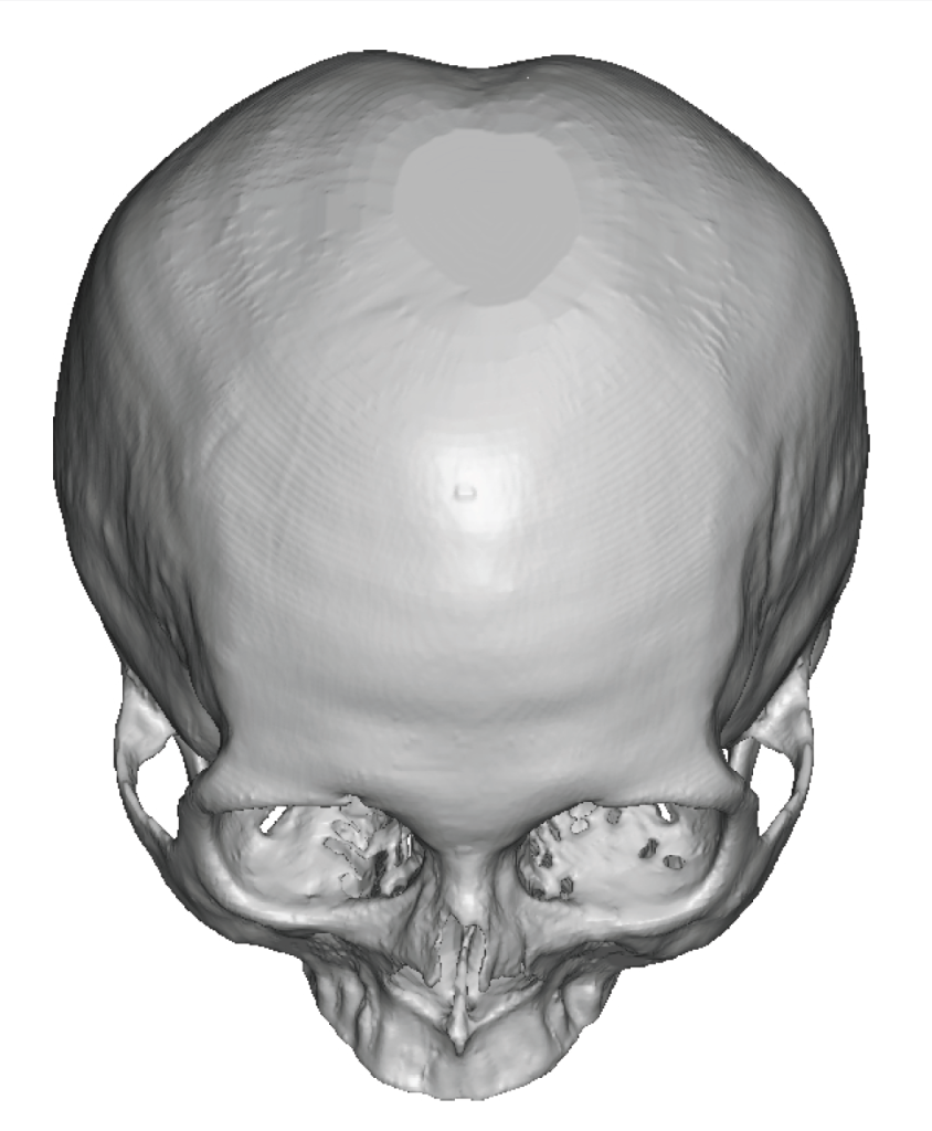 Plastic Surgery Case Study - Two Stage Large Skull Augmentation with ...