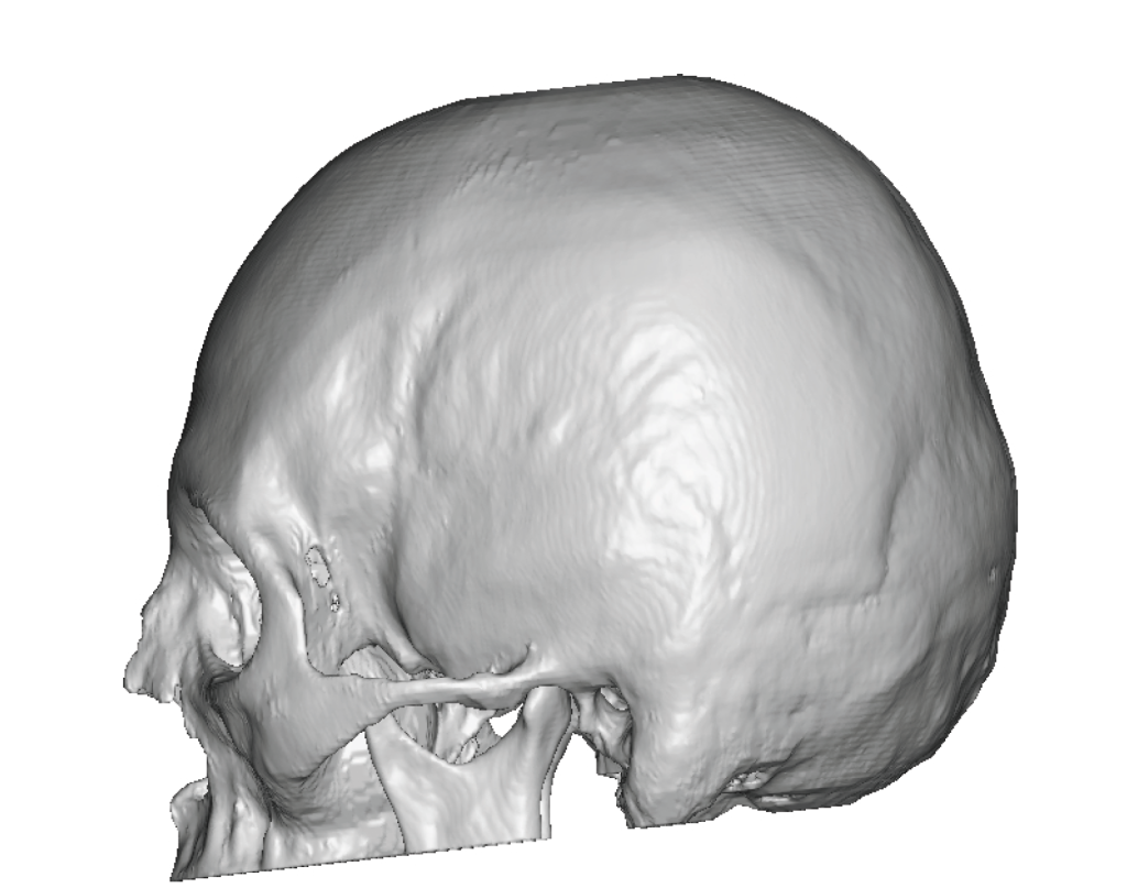 Plastic Surgery Case Study - Two Stage Large Skull Augmentation with ...