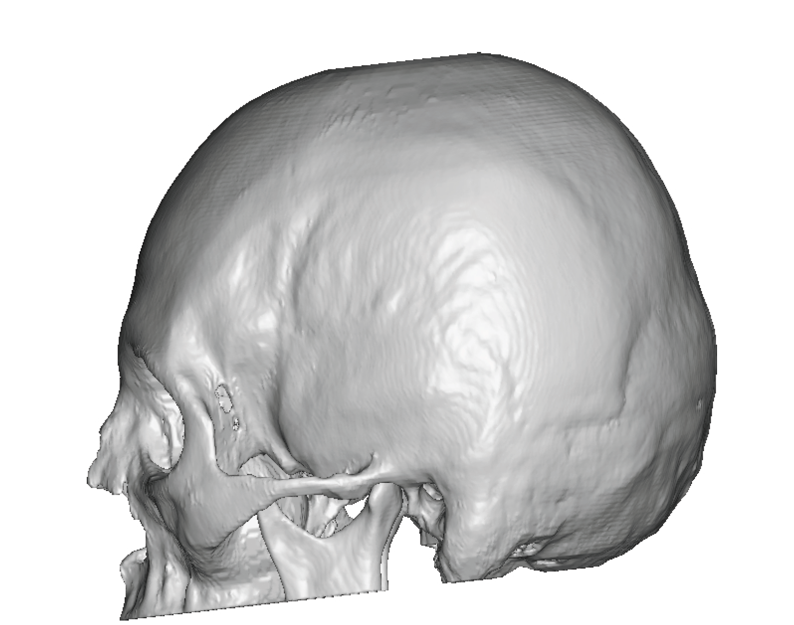 Plastic Surgery Case Study - Two Stage Large Skull Augmentation with ...