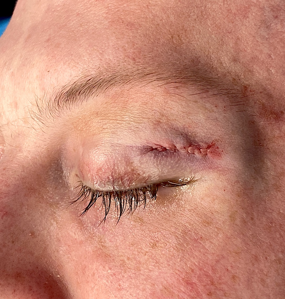 Plastic Surgery Case Study - Secondary Placement of Custom ...