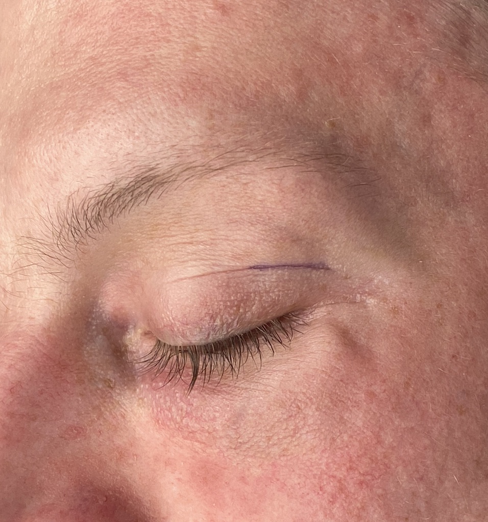 upper eyellid incision for custom orbital rim onlay implant Dr Barry ...