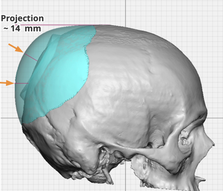 Plastic Surgery Case Study - Male Flat Back of the Head Custom Skull ...