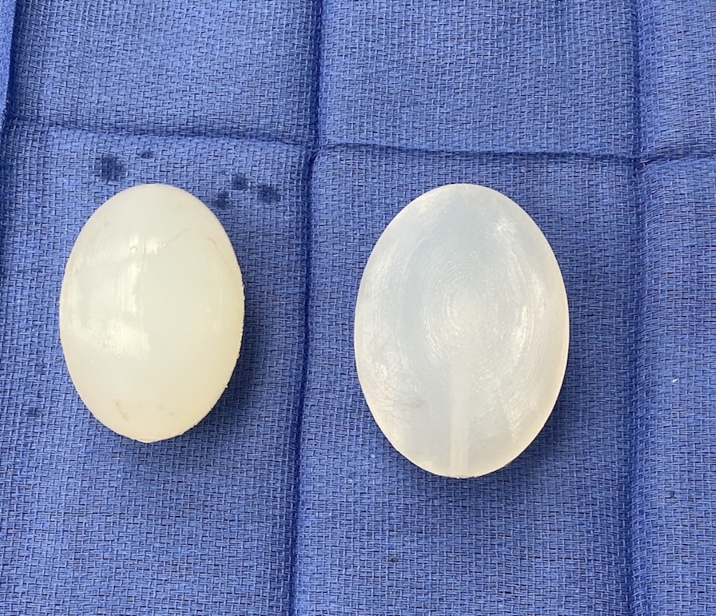 Plastic Surgery Case Study - The Three Stage Testicle Implant ...