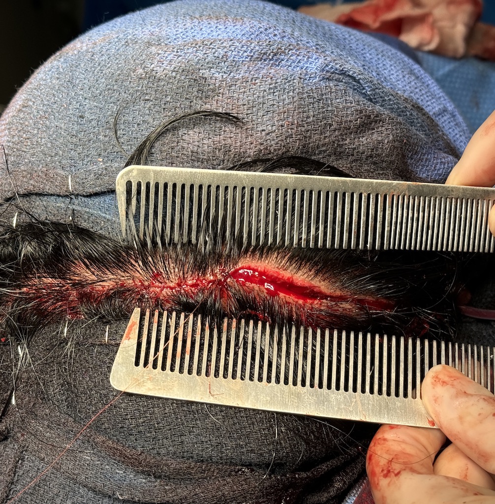 Plastic Surgery Case Study - Type 4 Temporal Reductions for Maximal ...