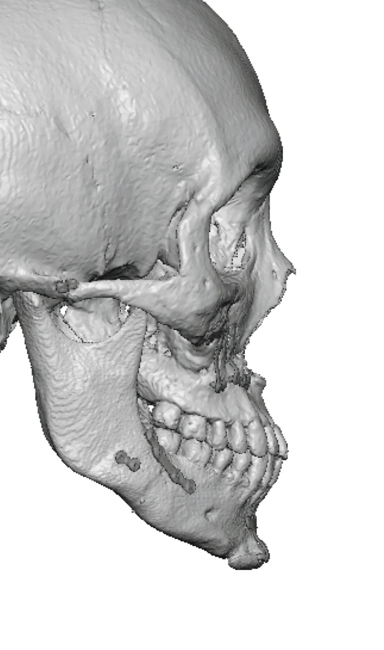 Plastic Surgery Case Study - Custom Cheek and Jawline Implants for V ...