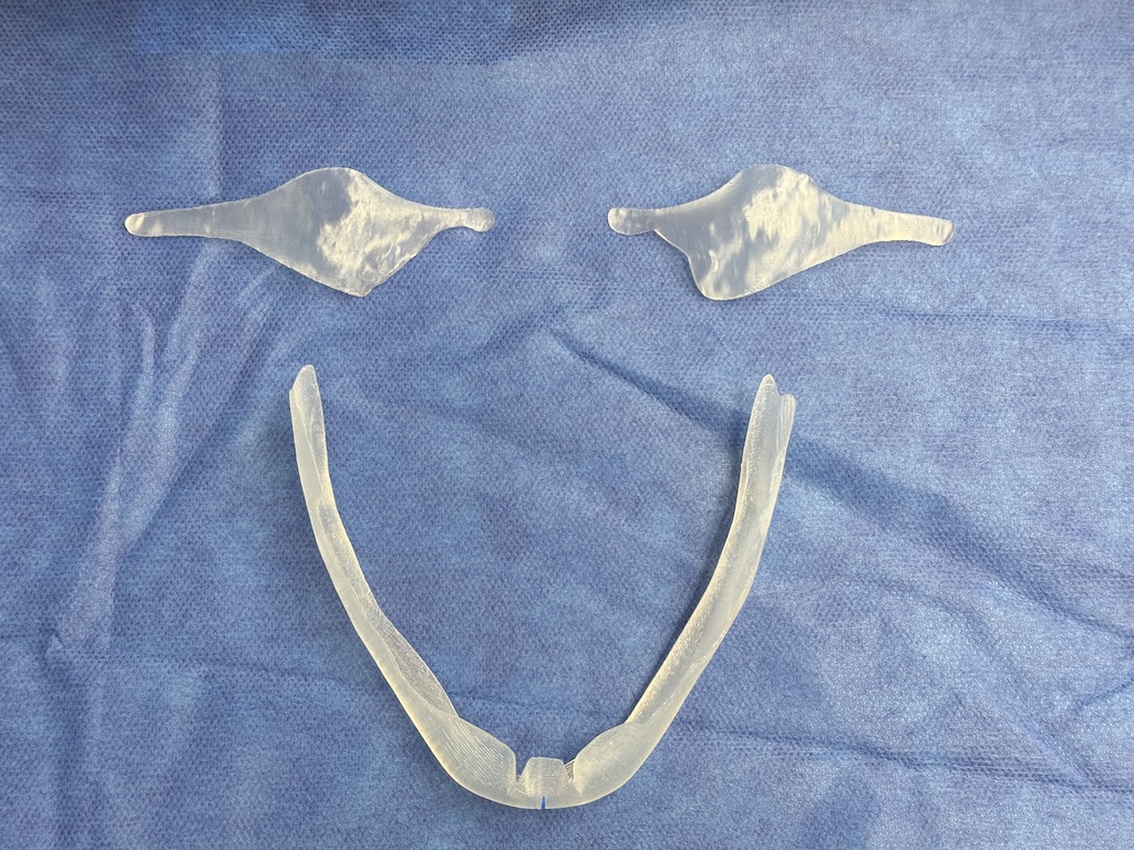 Plastic Surgery Case Study - Custom Cheek and Jawline Implants for V ...