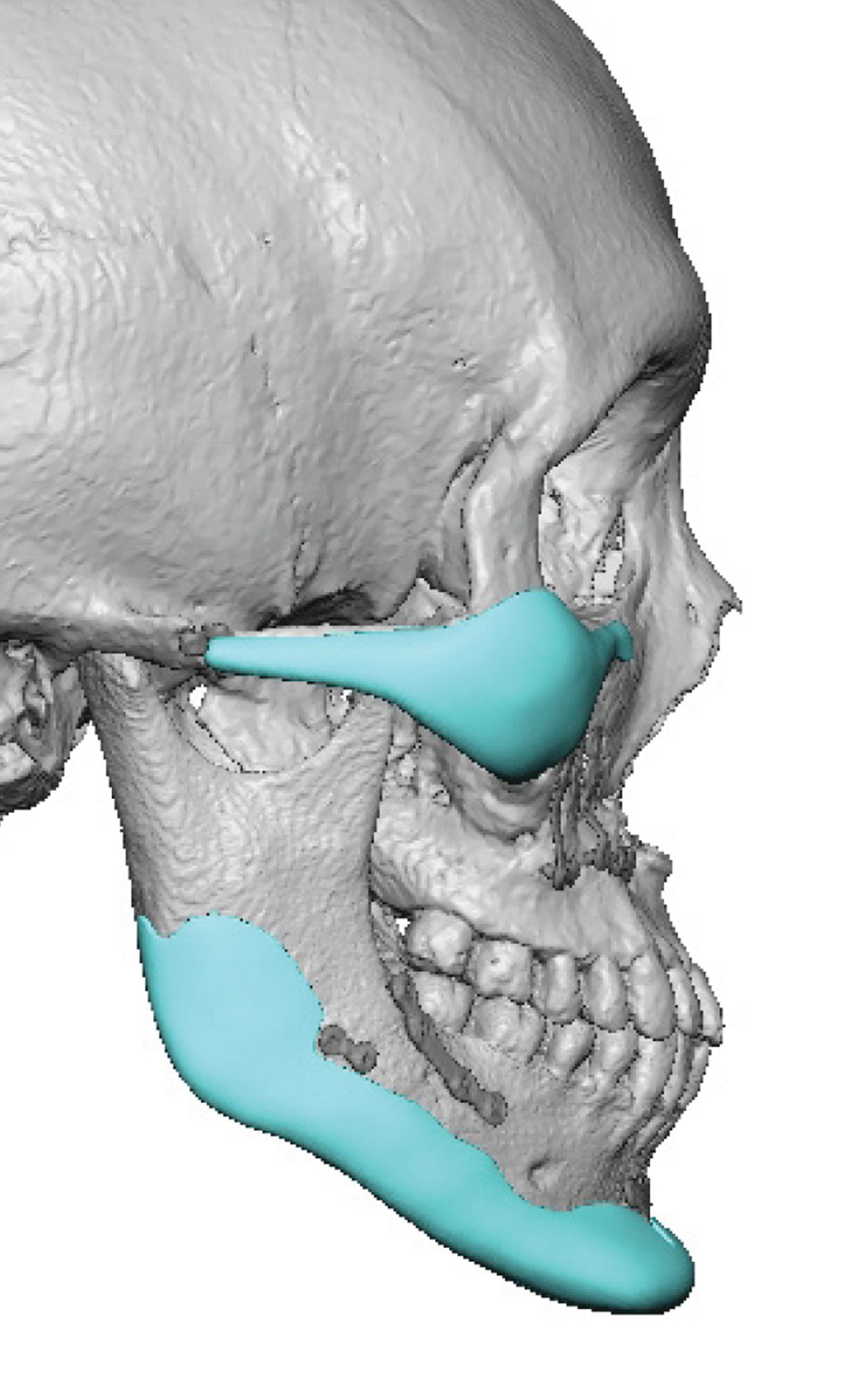 Plastic Surgery Case Study - Custom Cheek and Jawline Implants for V ...