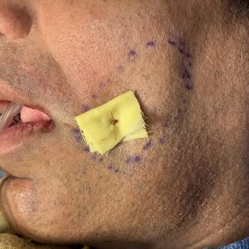 cheek reduction Archives - Explore Plastic Surgery