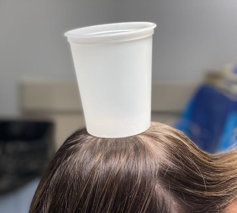 The Cup Test for Back of Head Augmentations with Custom Implants ...