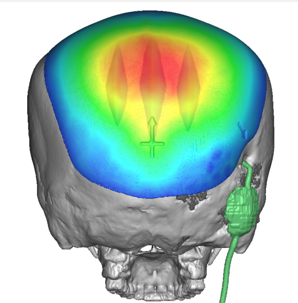 Plastic Surgery Case Study - Custom Skull Implant For Augmentation of ...