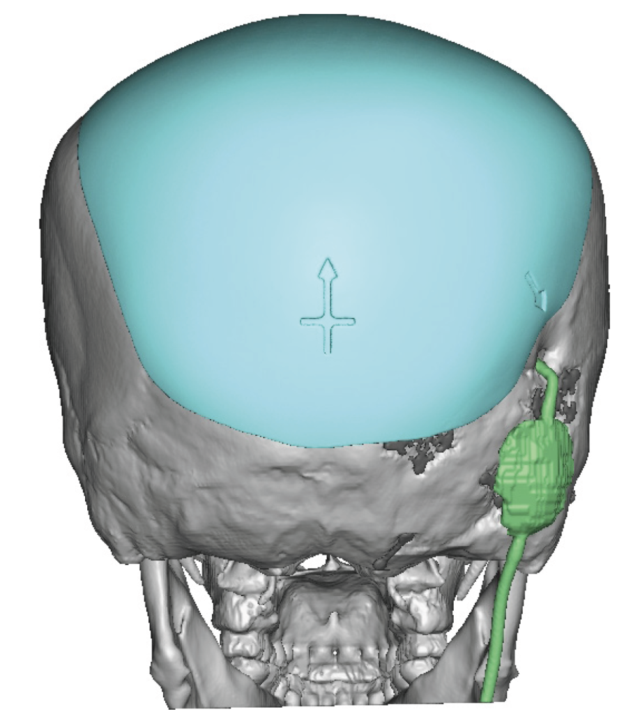 Plastic Surgery Case Study - Custom Skull Implant For Augmentation of ...
