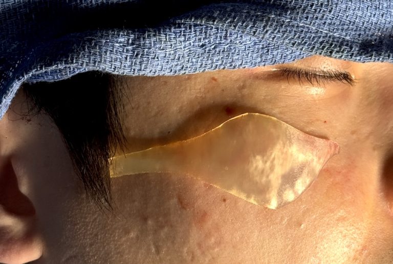 custom cheek implant for cheekbone reduction osteotomy reversal intraop ...