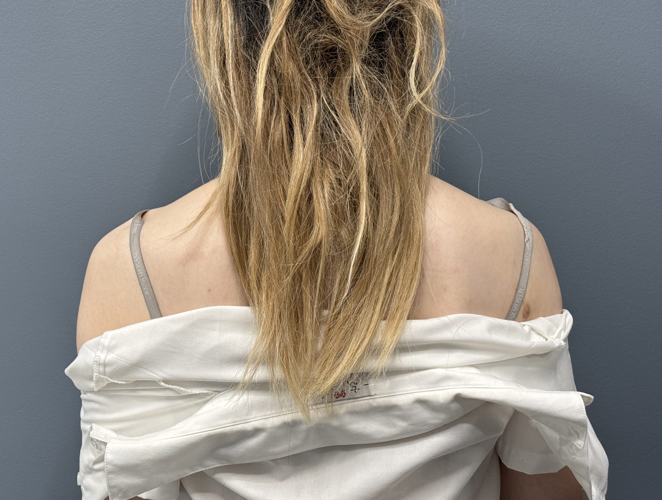 female asymmetric shoulders back 2 Dr Barry Eppley - Explore Plastic ...