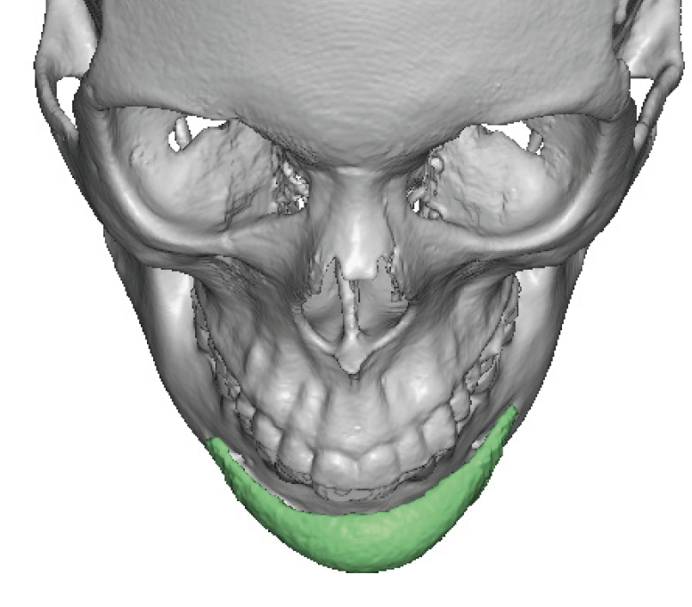 female chin implant top view 3D CT scan Dr Barry Eppley - Explore ...