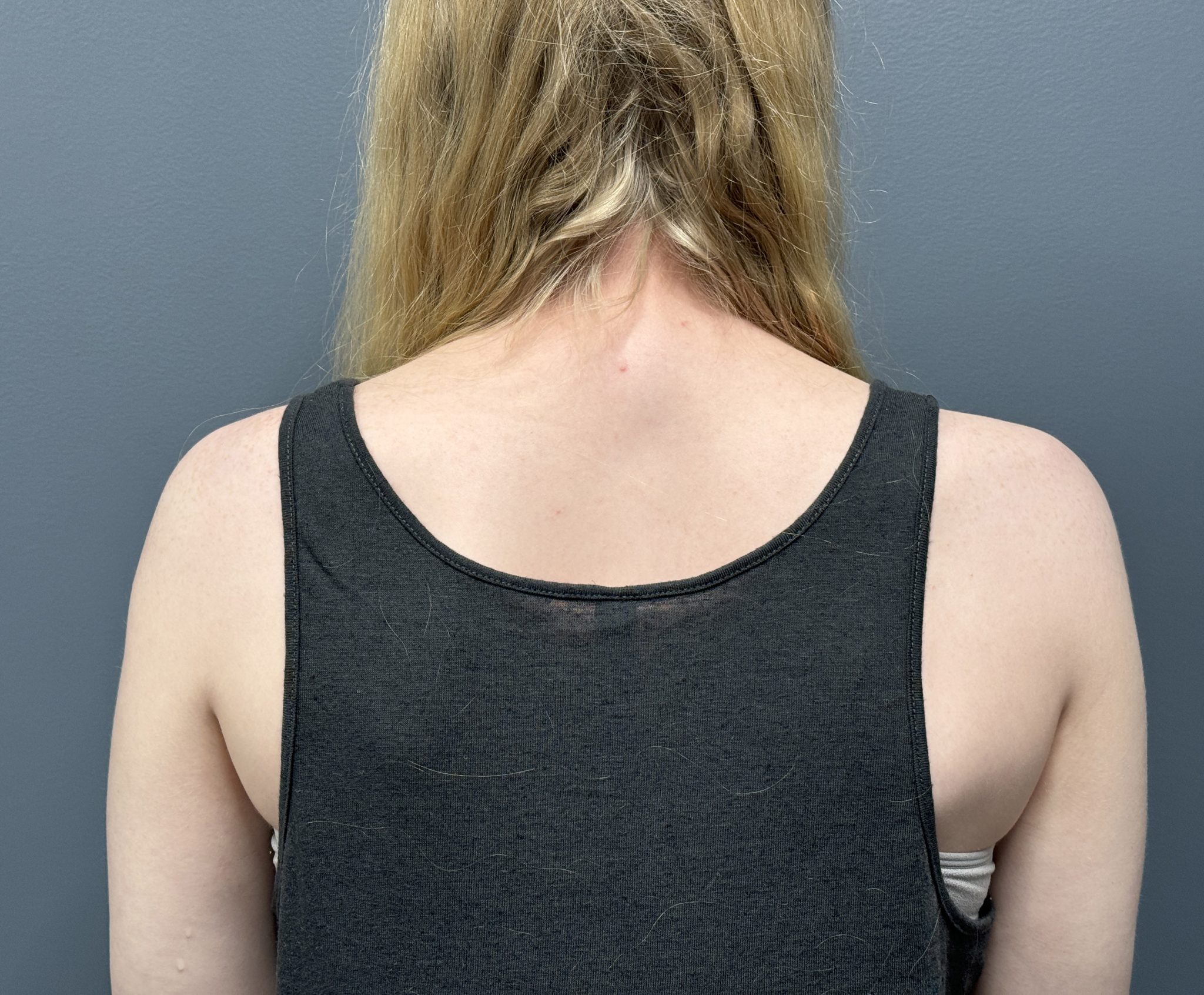 Plastic Surgery Case Study - Shoulder Narrowing Surgery with the Use of ...