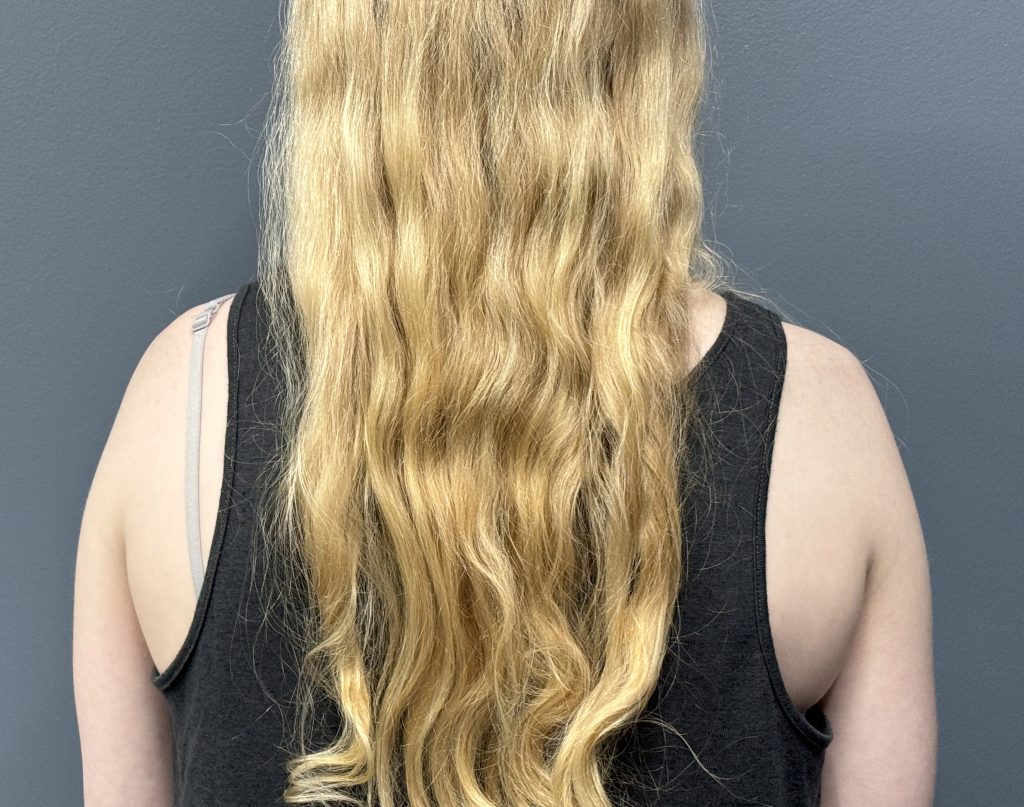 Plastic Surgery Case Study - Shoulder Narrowing Surgery with the Use of ...