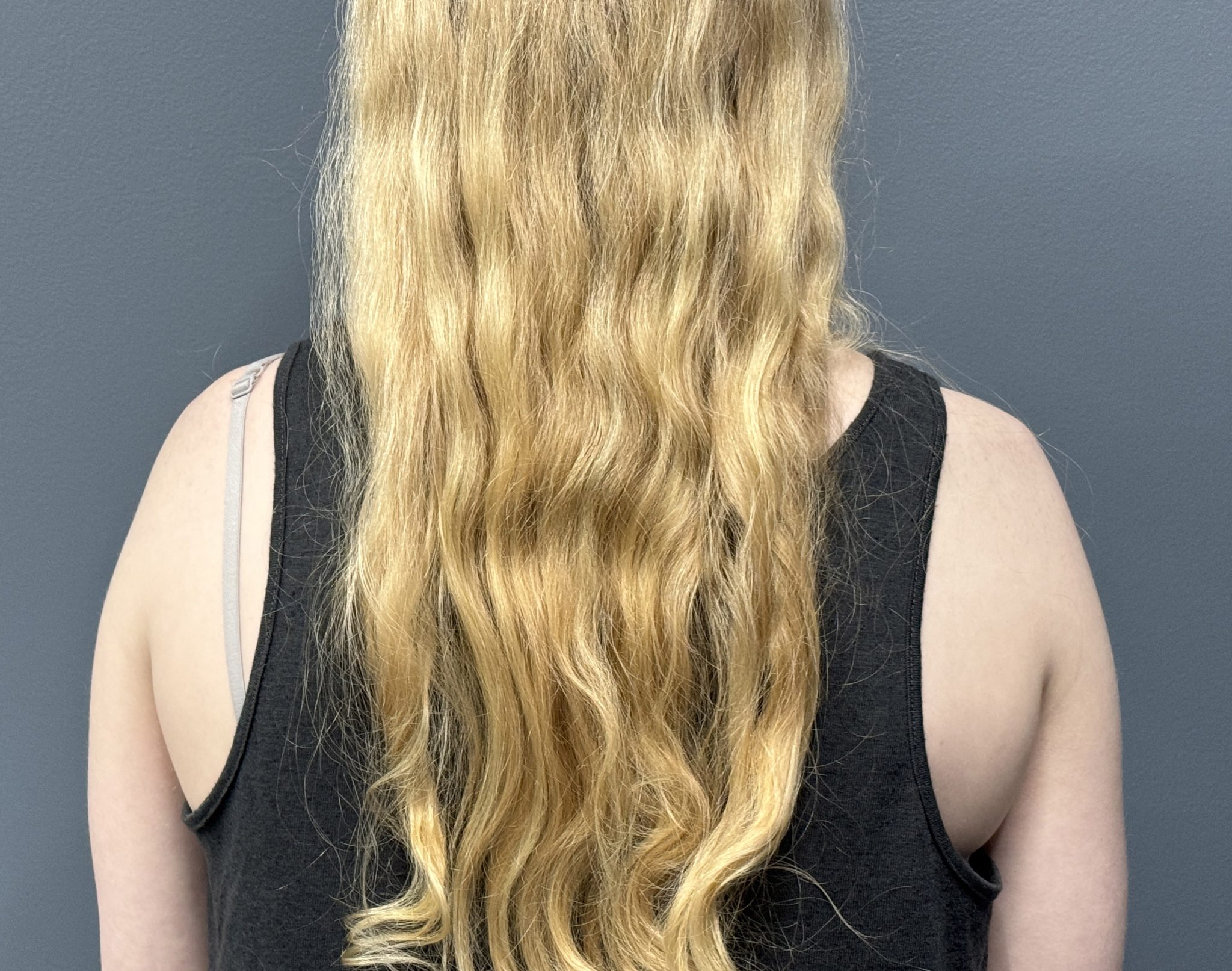 Plastic Surgery Case Study - Shoulder Narrowing Surgery with the Use of ...