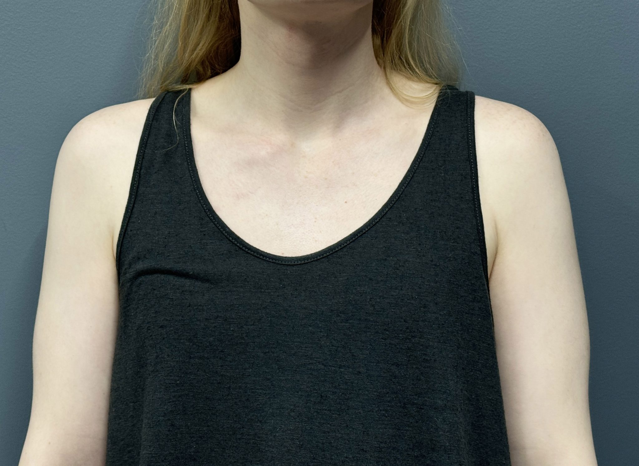 Plastic Surgery Case Study - Shoulder Narrowing Surgery with the Use of ...