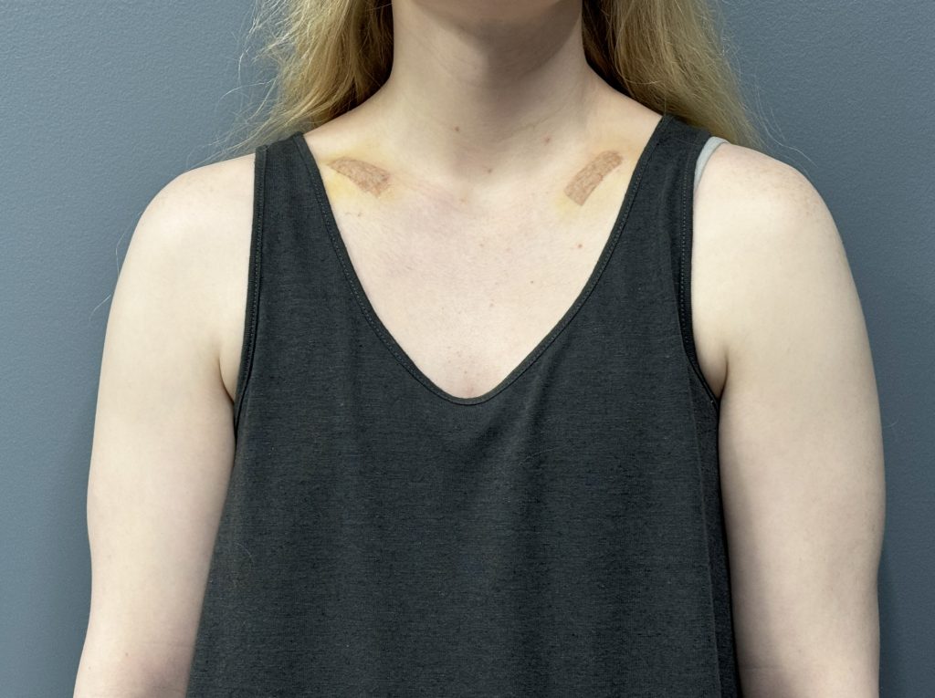 Plastic Surgery Case Study - Shoulder Narrowing Surgery with the Use of ...