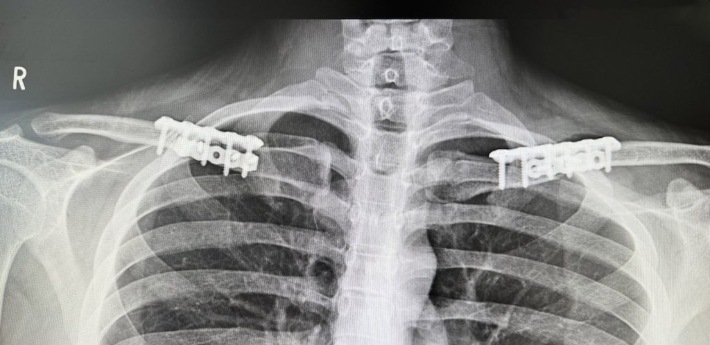 female shoulder reduction postop x ray Dr Barry Eppley - Explore ...